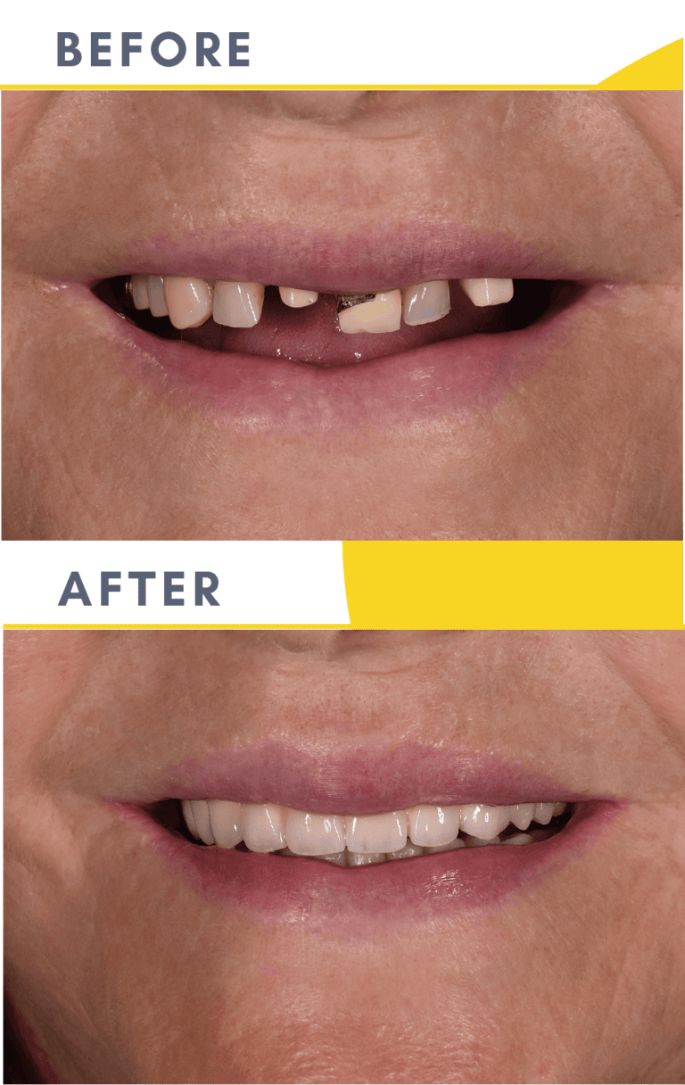 Coroane Dentare Bucuresti - Tot ce trebuie sa stii despre coroane dentare