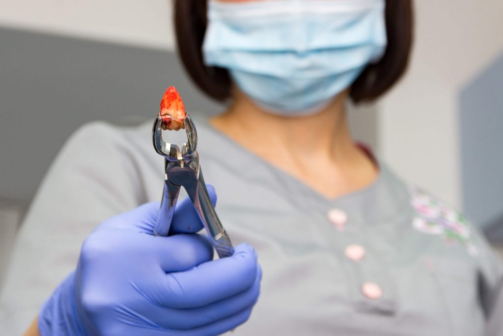 Extractie Dentara Bucuresti - Etape, tipuri, contraindicatii