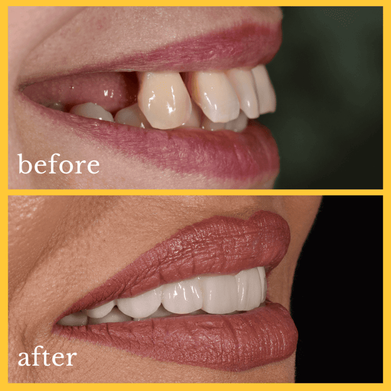 Implant Dentar de ultima generatie in Bucuresti | Clinica Dentaline